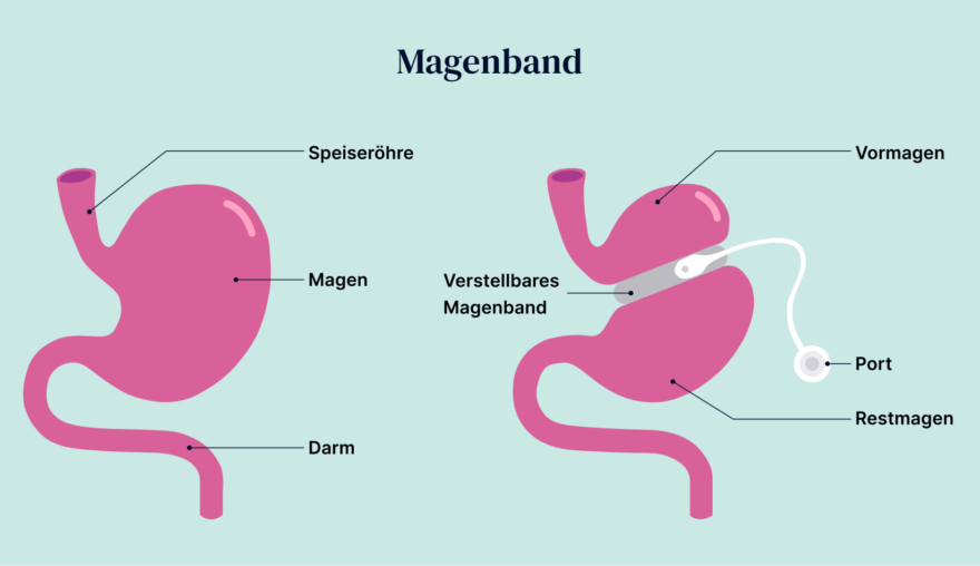 Magenband: Ist die OP für mich geeignet? | Oviva