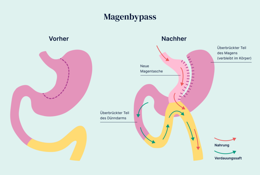 Magenverkleinerung: Wann ist die OP sinnvoll? | Oviva